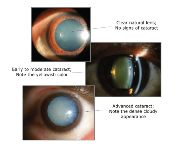 Cataracts 101: The Basics Of Cataract Surgery And What To Expect