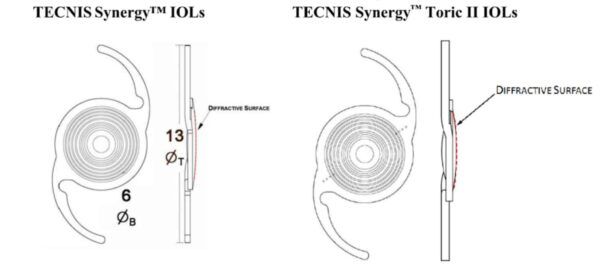 Synergy IOL Review | The Complete Patient Guide