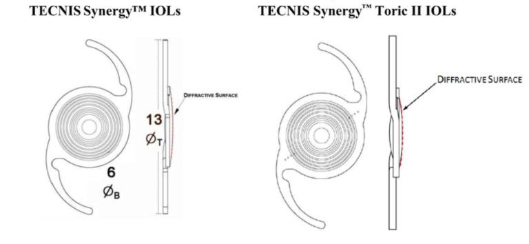 Synergy IOL Review | The Complete Patient Guide