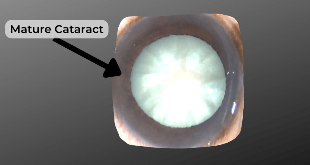 How Long Does Cataract Surgery Take? | Best Cataract Surgeons In America