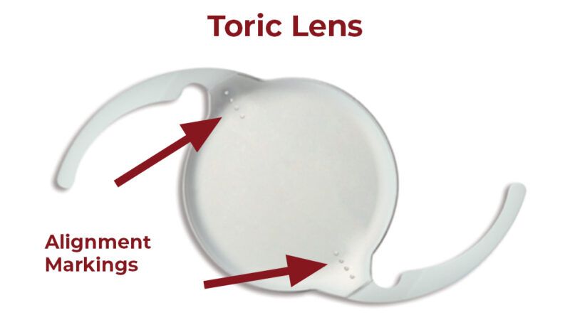What Does Medicare Cover For Cataract Surgery? | For Patients